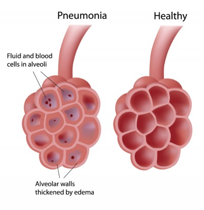About pneumonia - What is pneumonia?
